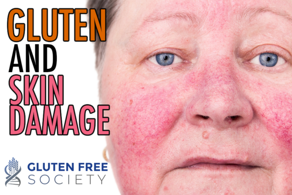 Gluten Allergy on Skin | Gluten Free Society