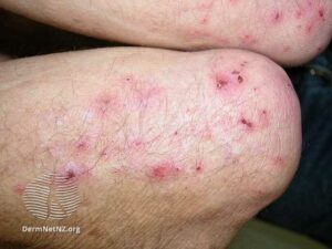 Celiac Rash: Could Gluten Be The Cause Of Your Adverse Skin Conditions ...