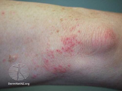 Celiac Rash: Could Gluten Be The Cause Of Your Adverse Skin Conditions ...