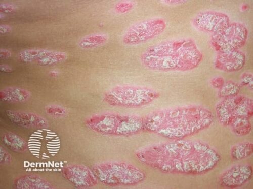 Celiac Rash: Could Gluten Be The Cause Of Your Adverse Skin Conditions ...