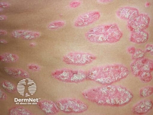 Celiac Rash: Could Gluten Be The Cause Of Your Adverse Skin Conditions ...