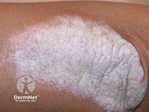 Celiac Rash: Could Gluten Be The Cause Of Your Adverse Skin Conditions ...